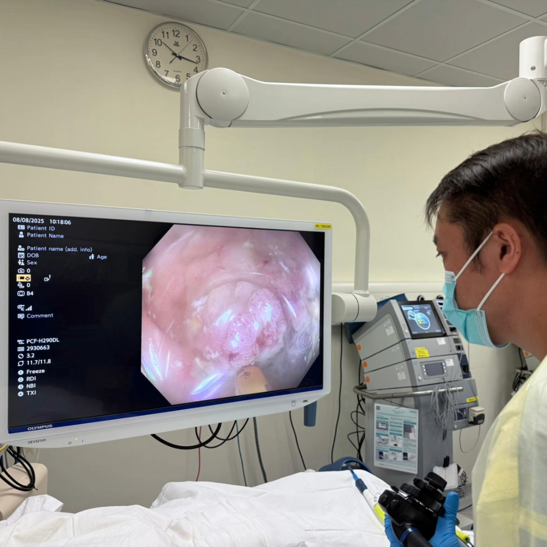 Speedboat Notch case: Dr Simon Chu - Colorectal ESD