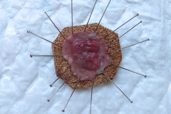 El caso de la lancha rápida: Dr. Álvaro Terán - ESD colorrectal